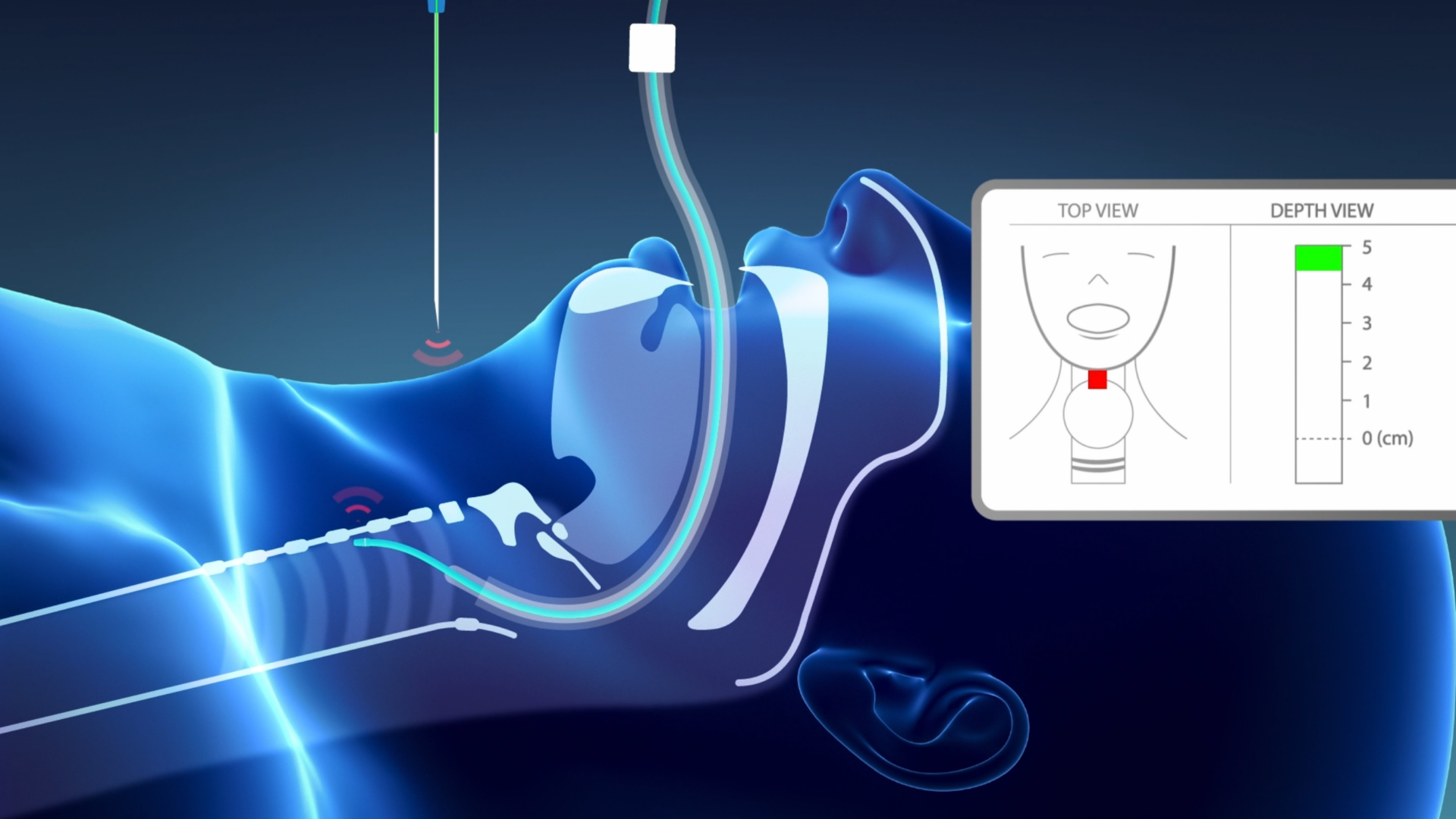 GiFT: Guidance for Tracheostomy - University of Manchester Innovation ...